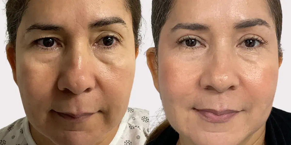 Before and After Gallery